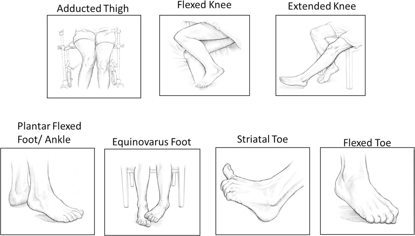 Spasticity - GC Rehab